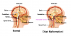 WHAT IS CHIARI? – The Chiari Project
